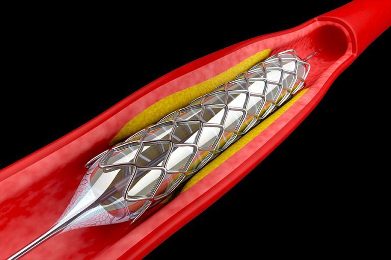 Stents, o que são e para que servem? - Blog Dr. Abdo Farret