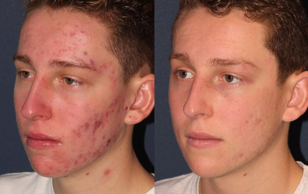 How to Get Rid of Acne - Abdullah Yahya