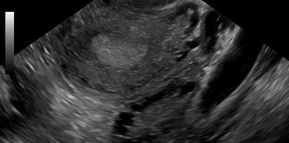 How are uterine polyps diagnosed and treated? | Euromed® Clinic