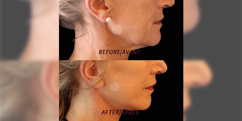 Facelift in Dubai - Remove Aging Signs with Face Lift Surgery | Euromed ...