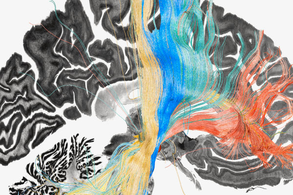 Transformation through Innovative Brain Mapping: A Breakthrough for OCD ...