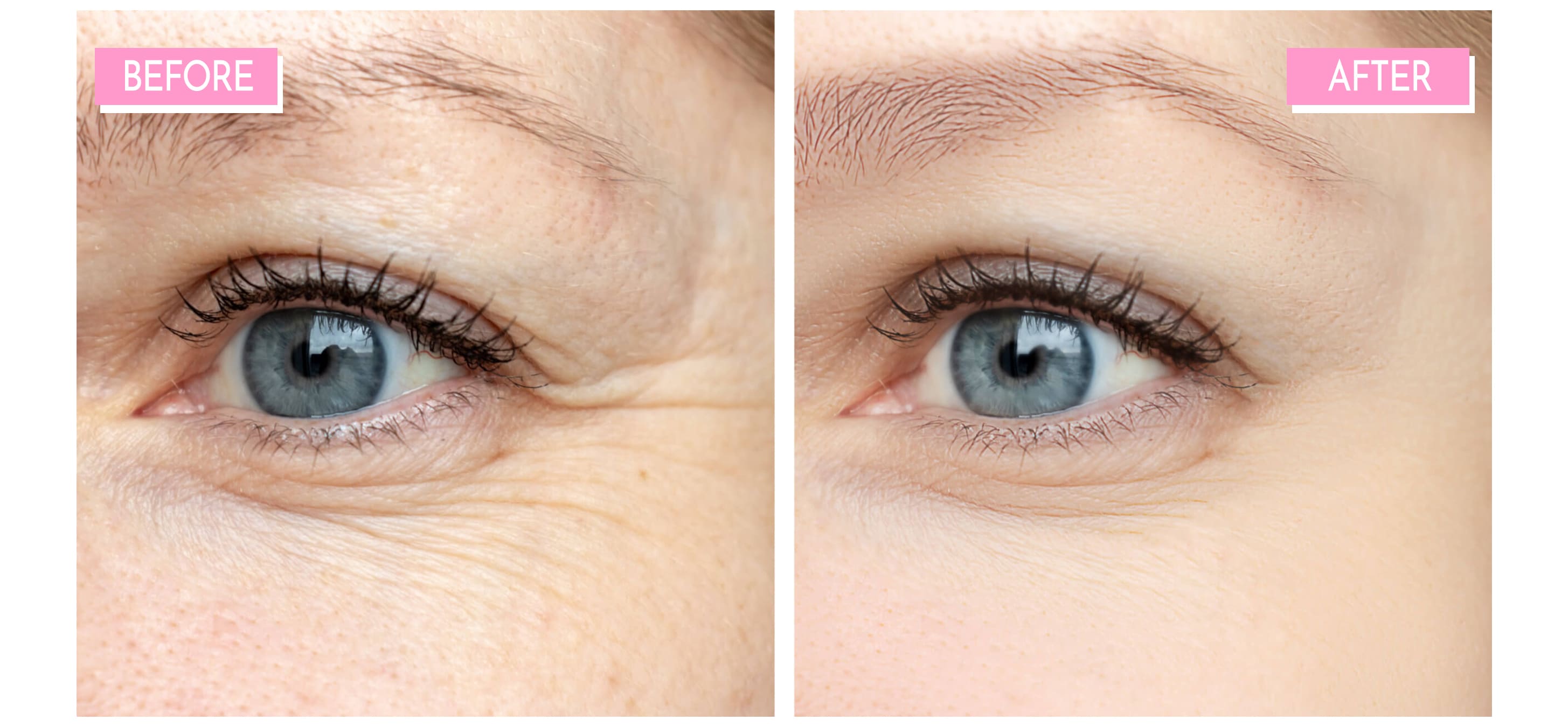 Daxxify Vs. Botox: Which Injectable is Best for You?