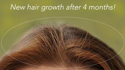 היירמקס | טיפול בנשירת שיער עם מברשת הלייזר מאמריקה | HairMax