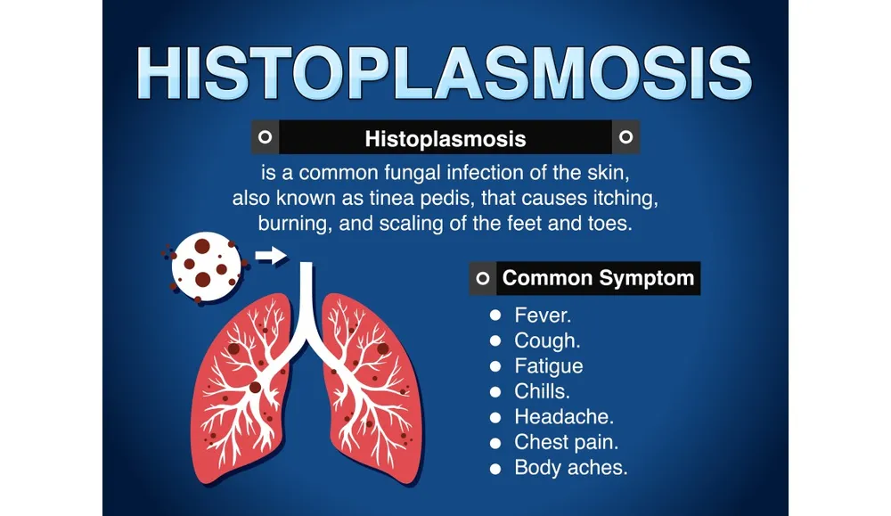 Histoplasmosis