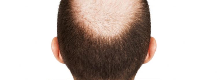 Diffuse Unpatterned Alopecia (DUPA) Causes and How to Treat It? | Hair ...