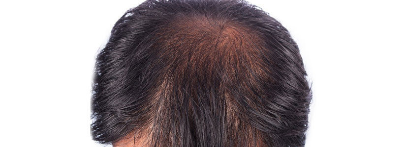 12 Highly Effective Treatments and Tips for Hair Thinning | Hair ...