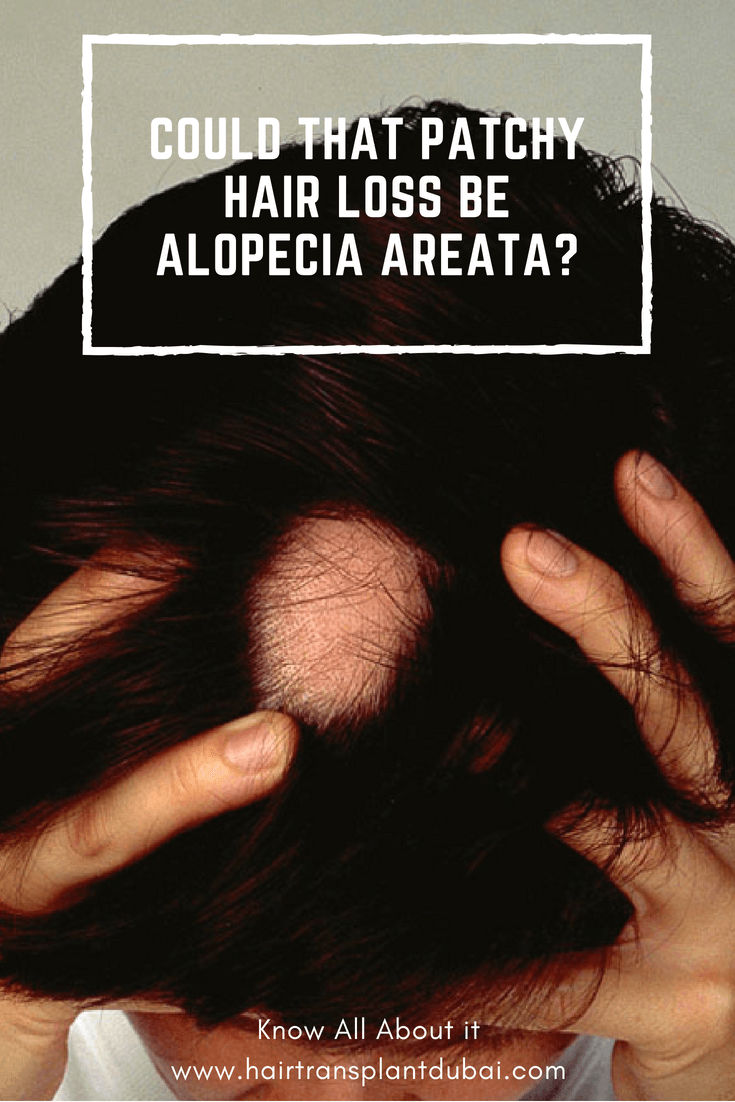 Could that patchy hair loss be Alopecia Areata? | Hair Transplant Dubai