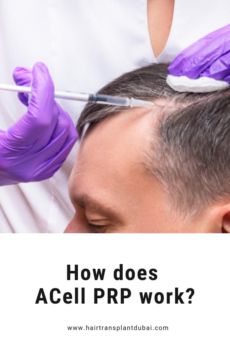How Does Acell Prp Work Hair Transplant Dubai