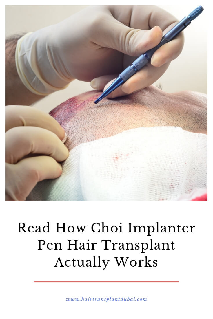 Read How Choi Implanter Pen Hair Transplant Actually Works | Hair ...