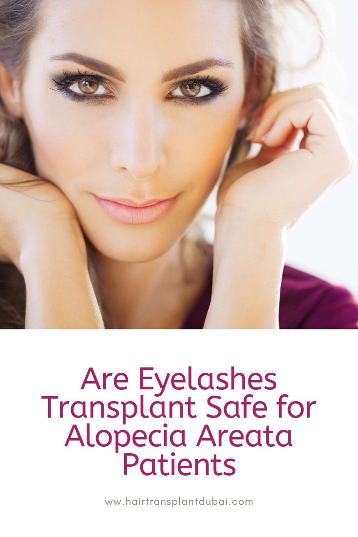 Are Eyelashes Transplant Safe for Alopecia Areata Patients | Hair ...