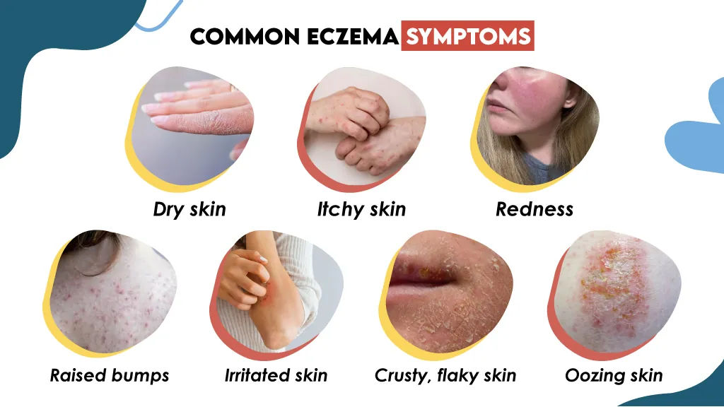 Homeopathy Remedies for Eczema in Gaur City - Isokorigari Lovable ...