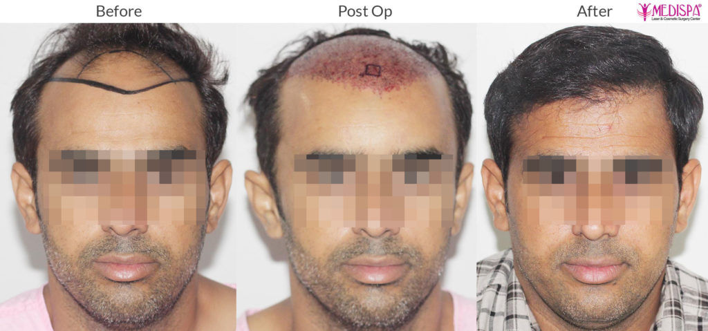 Why is the Giga/Mega Hair Transplant Session Required
