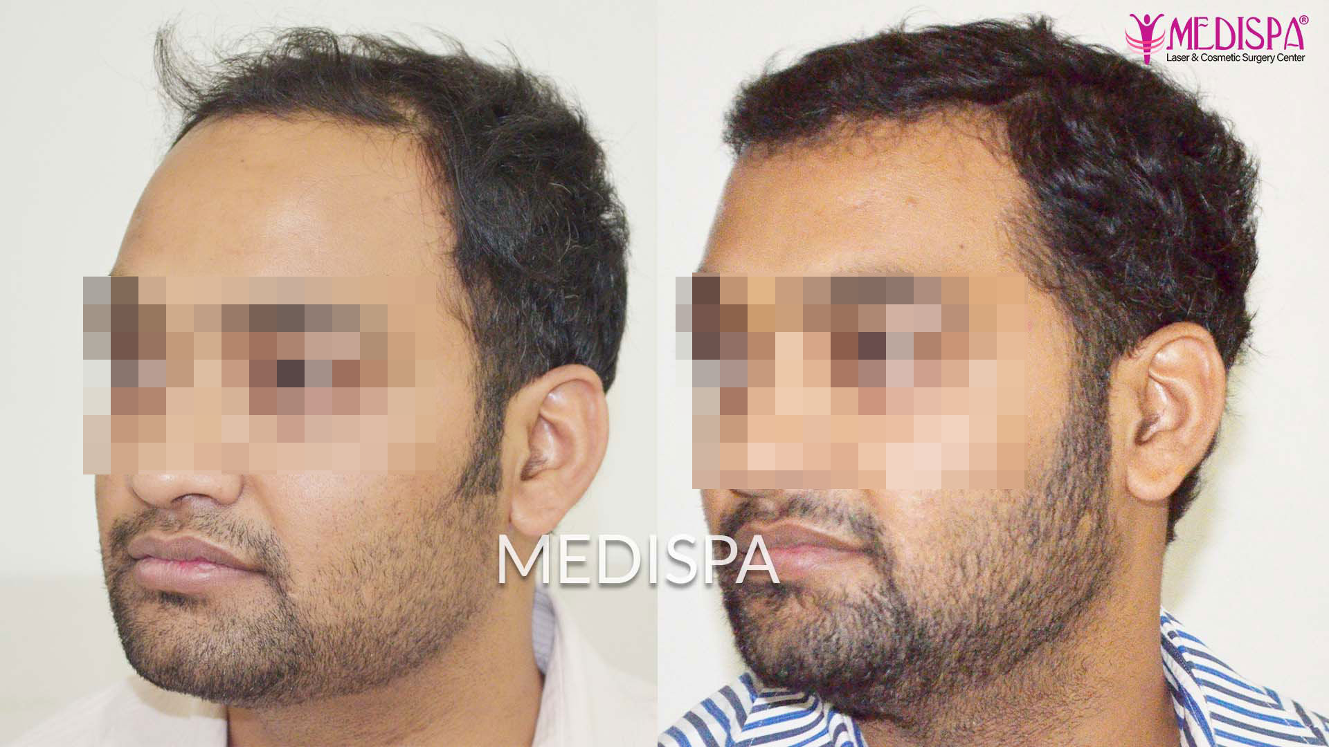 Achieving Appropriate Density in Hair Transplantation | Medispa India