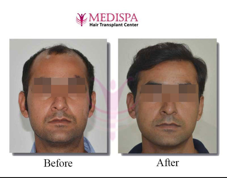 Importance Of Trichophytic Closure In FUT Hair Transplant