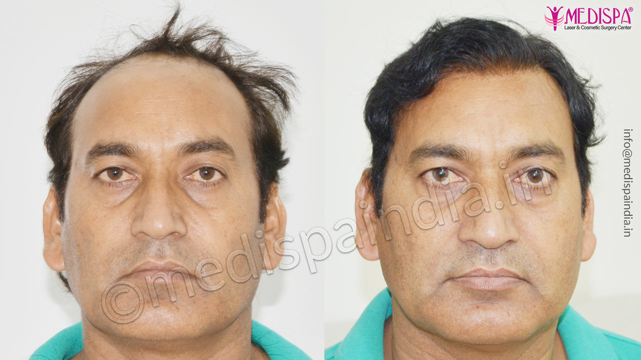 Best Hair Transplant Results In Delhi Before After Results