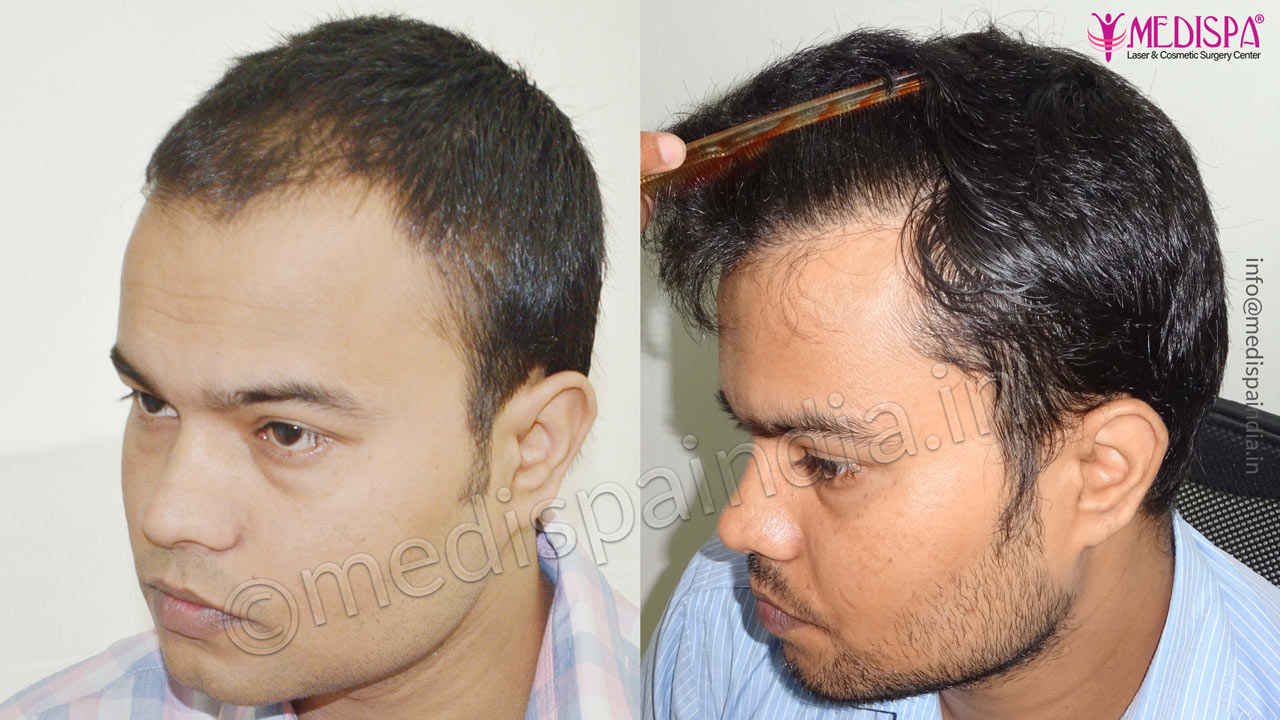 Before After Hair Transplant Results In Chennai India