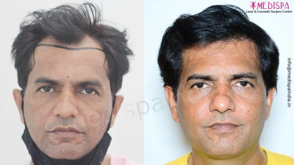 Why is the Giga/Mega Hair Transplant Session Required