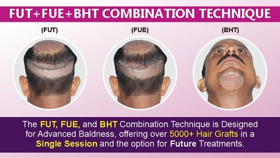 Facts You Must Know About FUT+FUE+BHT Combination Method