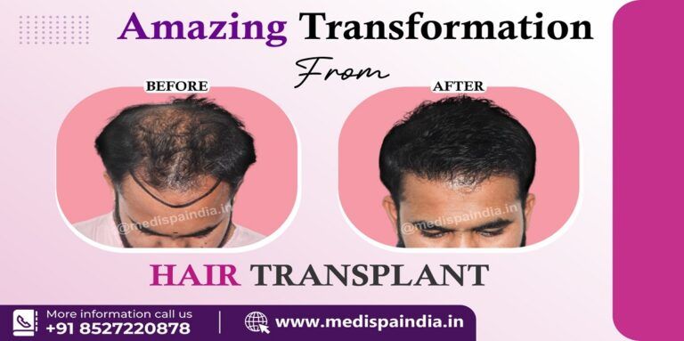 Importance Of Trichophytic Closure In FUT Hair Transplant