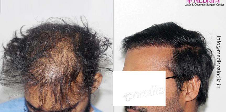 bad hair transplant correction india