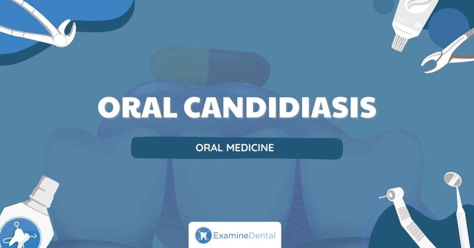 Oral Candidiasis - Types and Management - ExamineDental
