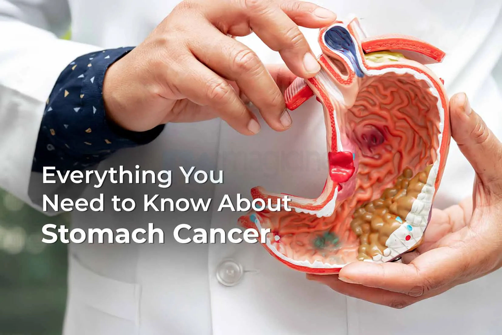 Understanding Stomach Cancer: Causes, Symptoms, Types, Diagnosis ...