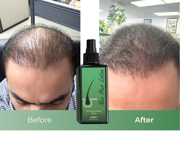 Regrow Hair with Neo Hair Lotion in Dubai | Green Wealth, UAE