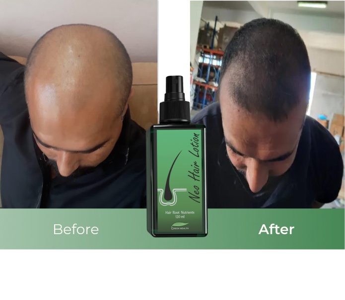 Regrow Hair with Neo Hair Lotion in Dubai | Green Wealth, UAE