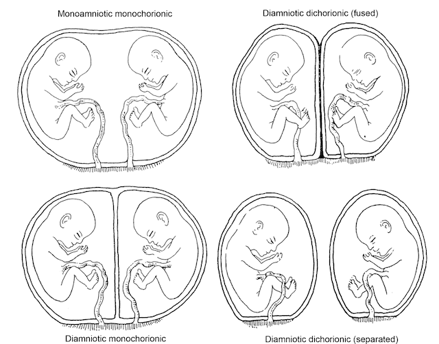 Very Rare “Mono Mono” Twins — 2 Sets, 1 Hospital, 1 Week