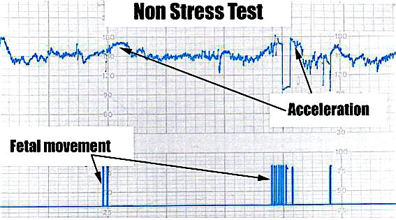 Non-Stress Test - NST