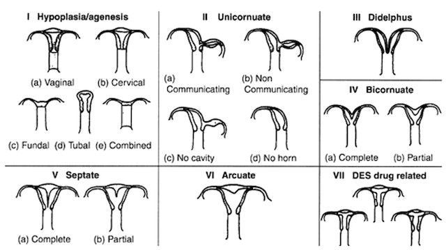What Is A Bicornuate Uterus?