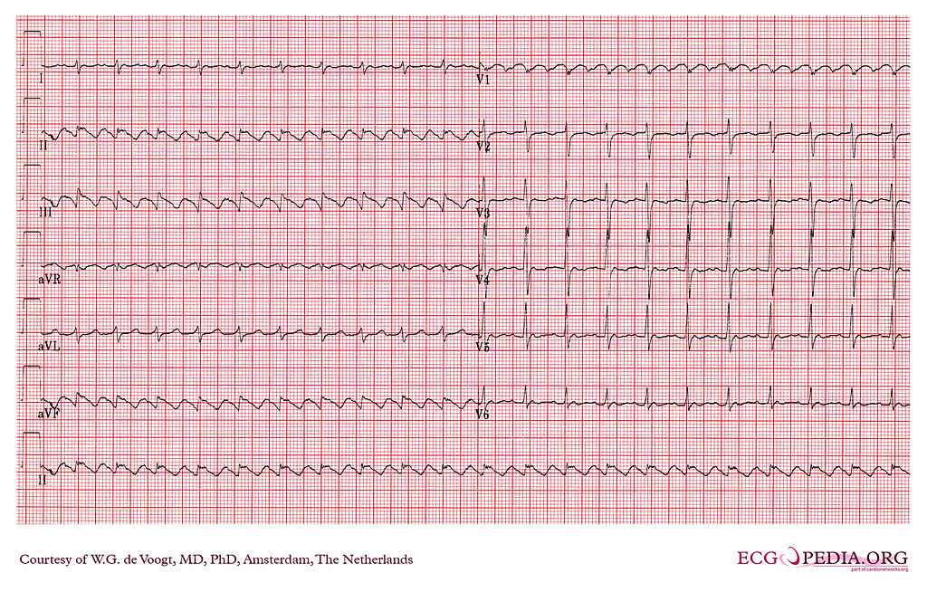 Arrhythmias (Tachyarrhythmias) | REVISEMLA