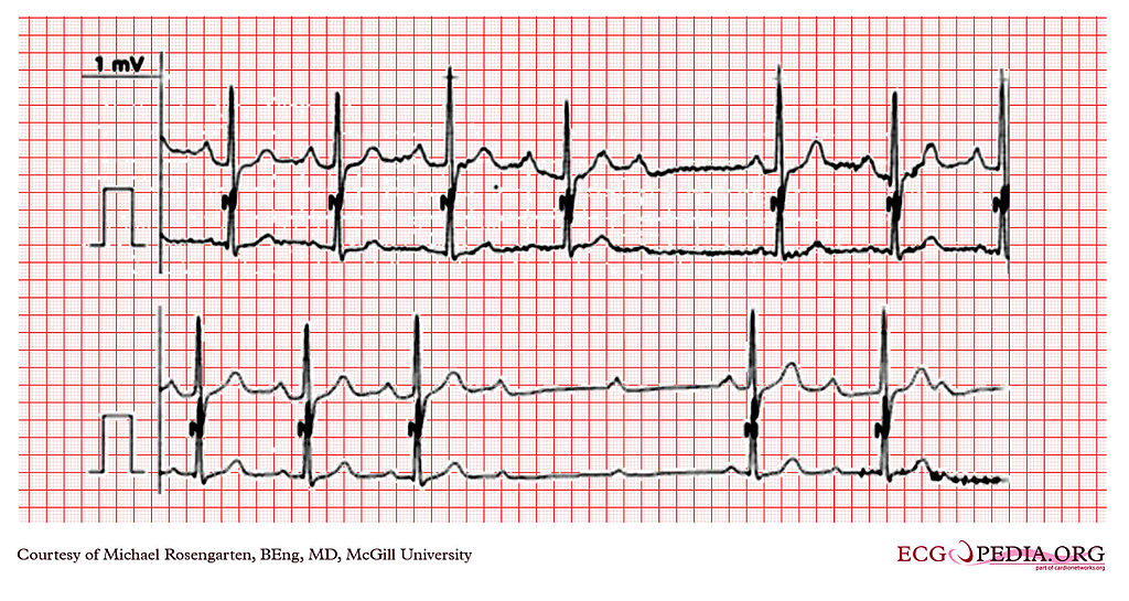 🐢 Arrhythmias (Bradyarrhythmias) | REVISEMLA