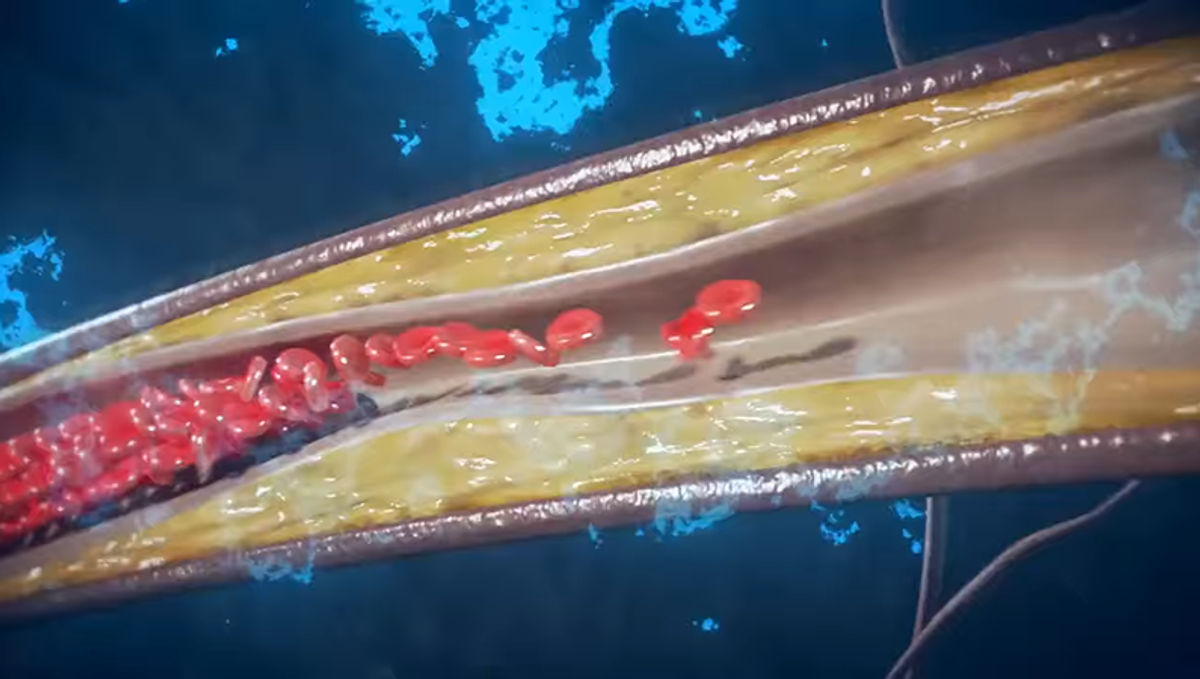 Buy The Phoenix - Acoustic Wave Therapy Device