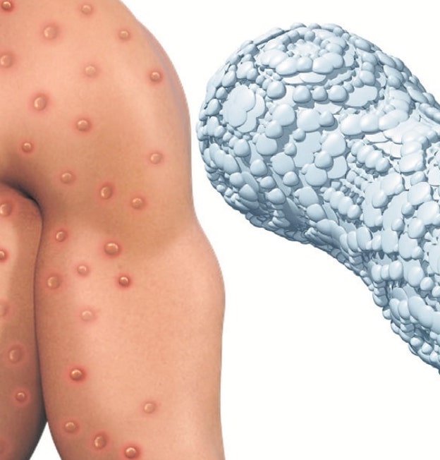 O que já se sabe sobre a nova varíola e como é possível se proteger ...