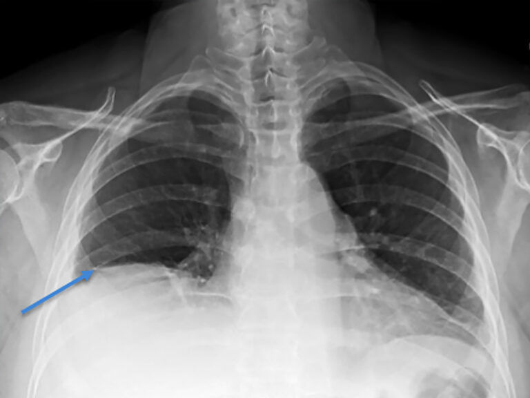 What Is White Lung Syndrome? A Mysterious Pneumonia Outbreak, Similar ...