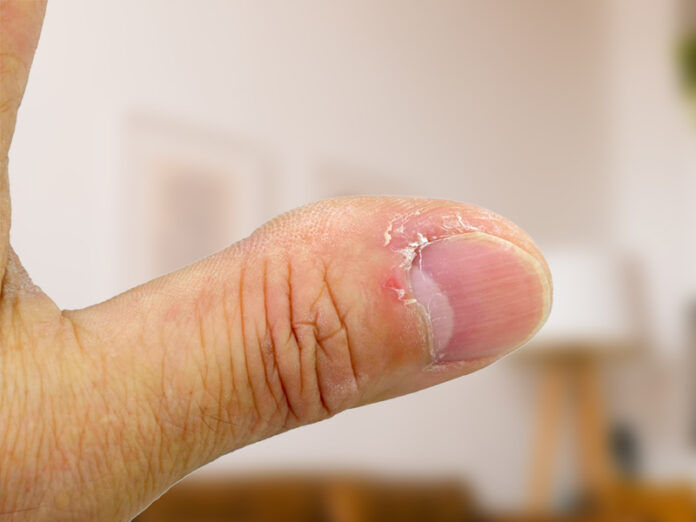 Dry Cuticles: What Causes It and How Can I Fix It?