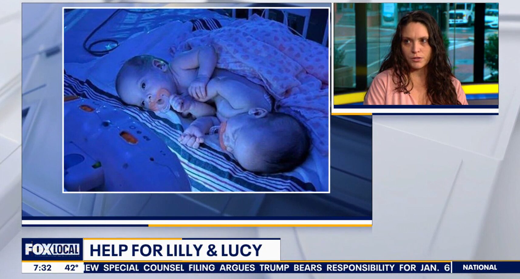 Conjoined twins to be separated at Children's Hospital of Philadelphia