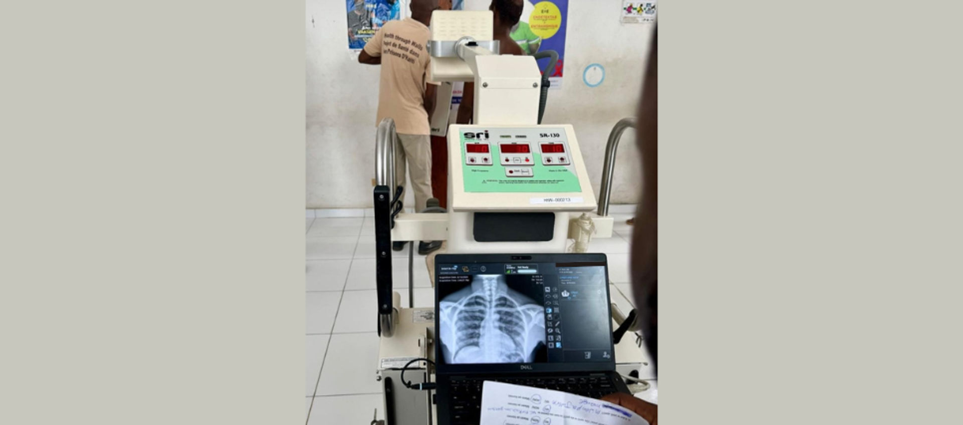 Portable X-Ray Systems: Advancing Tuberculosis Detection in ...