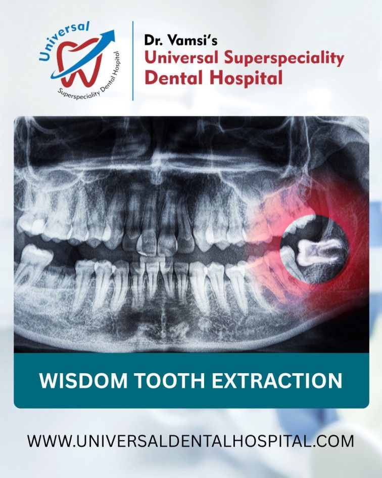 Wisdom Tooth Extraction – A Complete Guide for Pain-Free Recove … - 3 ...