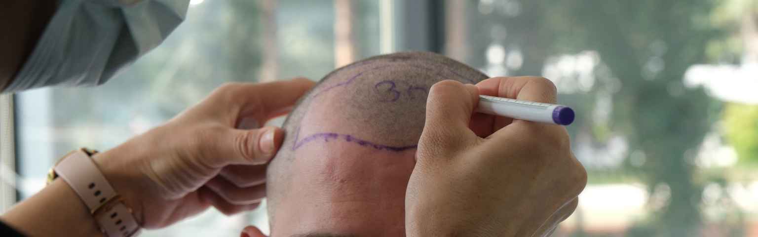 Tanam Rambut: Solusi Permanen untuk Kebotakan dan Kerontokan Rambut