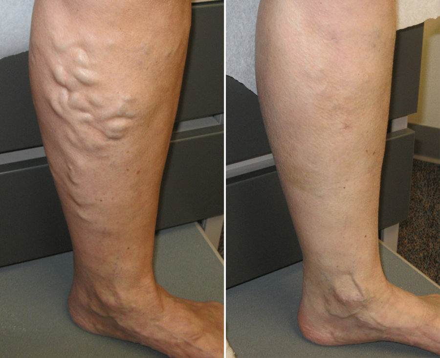 What Are Some Facts About Veins 