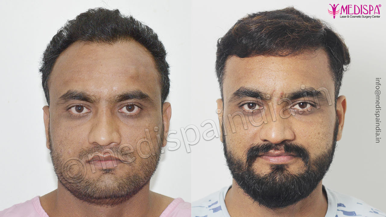 Male Hair Transplant Photo Gallery Hair Transplant Dubai Cost