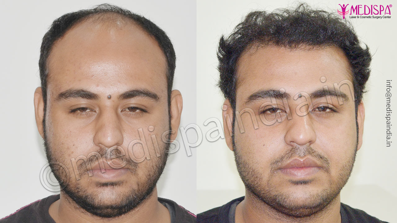 Male Hair Transplant Photo Gallery 4 Hair Transplant Dubai Cost
