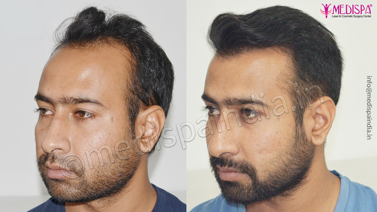 Hair Transplant Hyderabad Before After Hair Transplant Dubai Cost