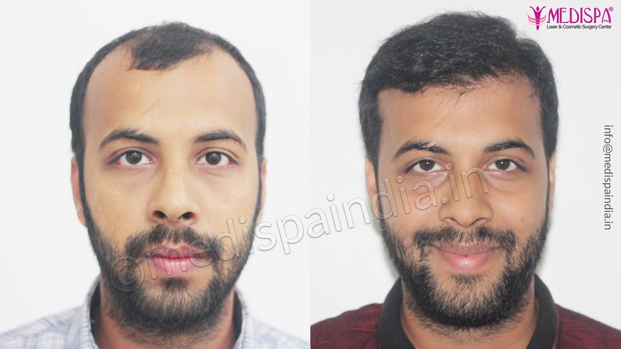Hair Transplant Results Andaman Nikobar Hair Transplant Dubai Cost