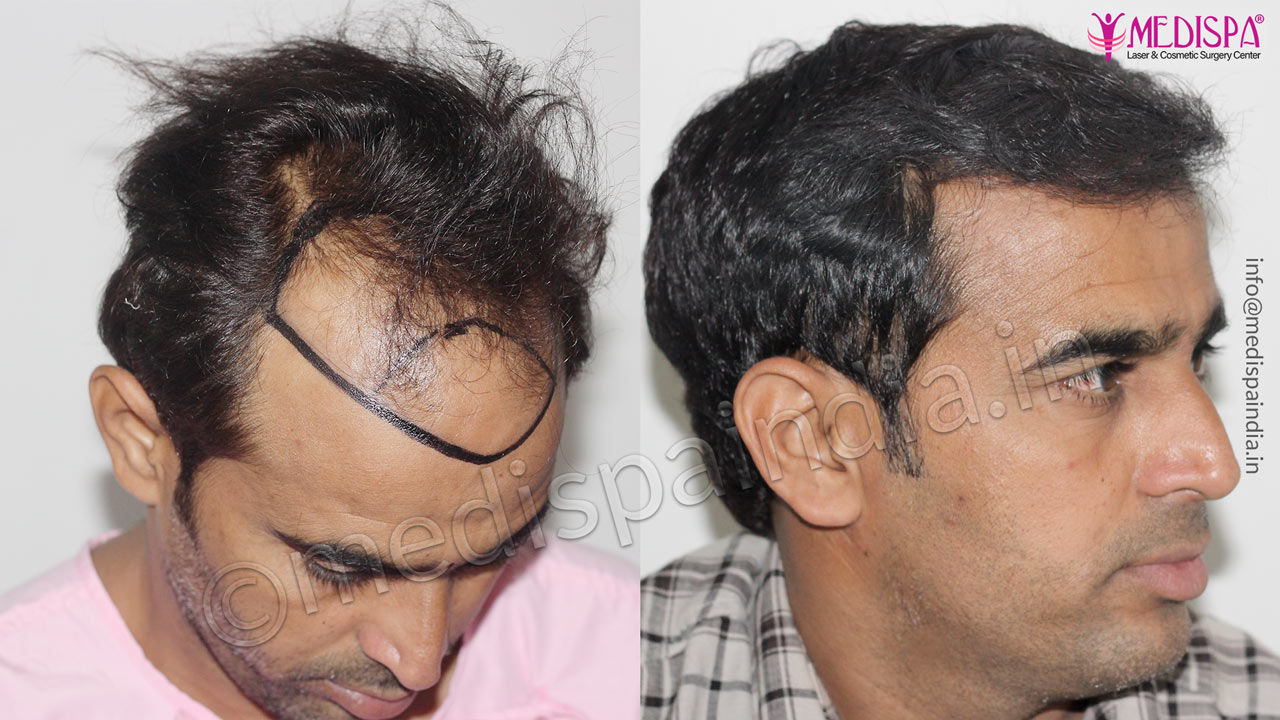 Hair Transplant Clinics In Indore Hair Transplant Dubai Cost