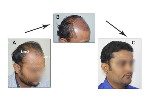 intersecting-point-of-temporal-triangle – Hair Transplant Dubai Cost
