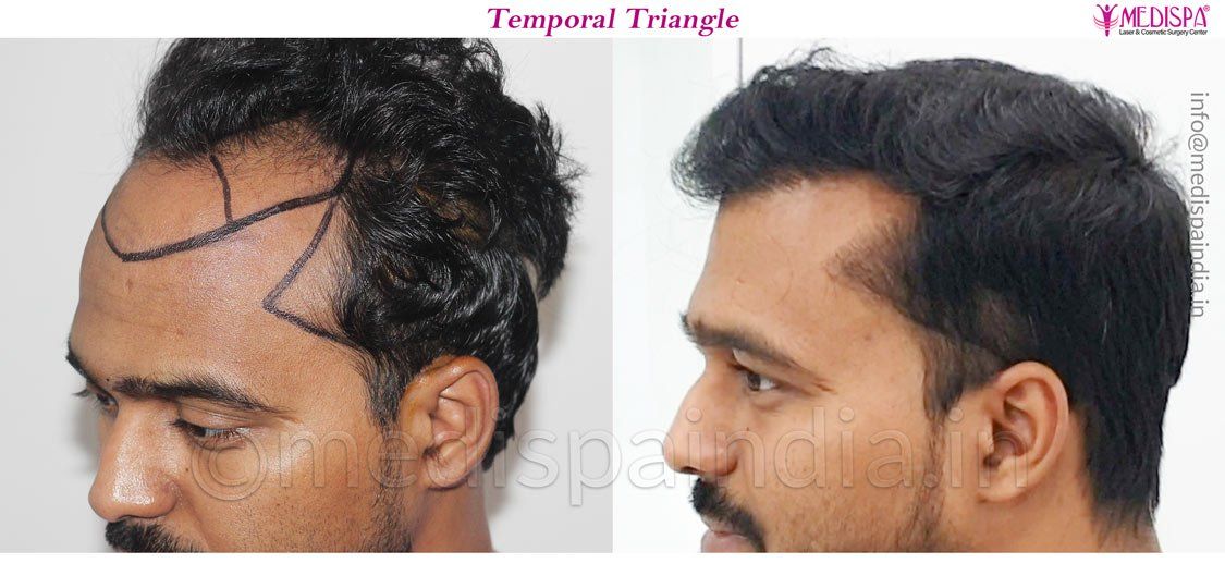temporal-all – Hair Transplant Dubai Cost
