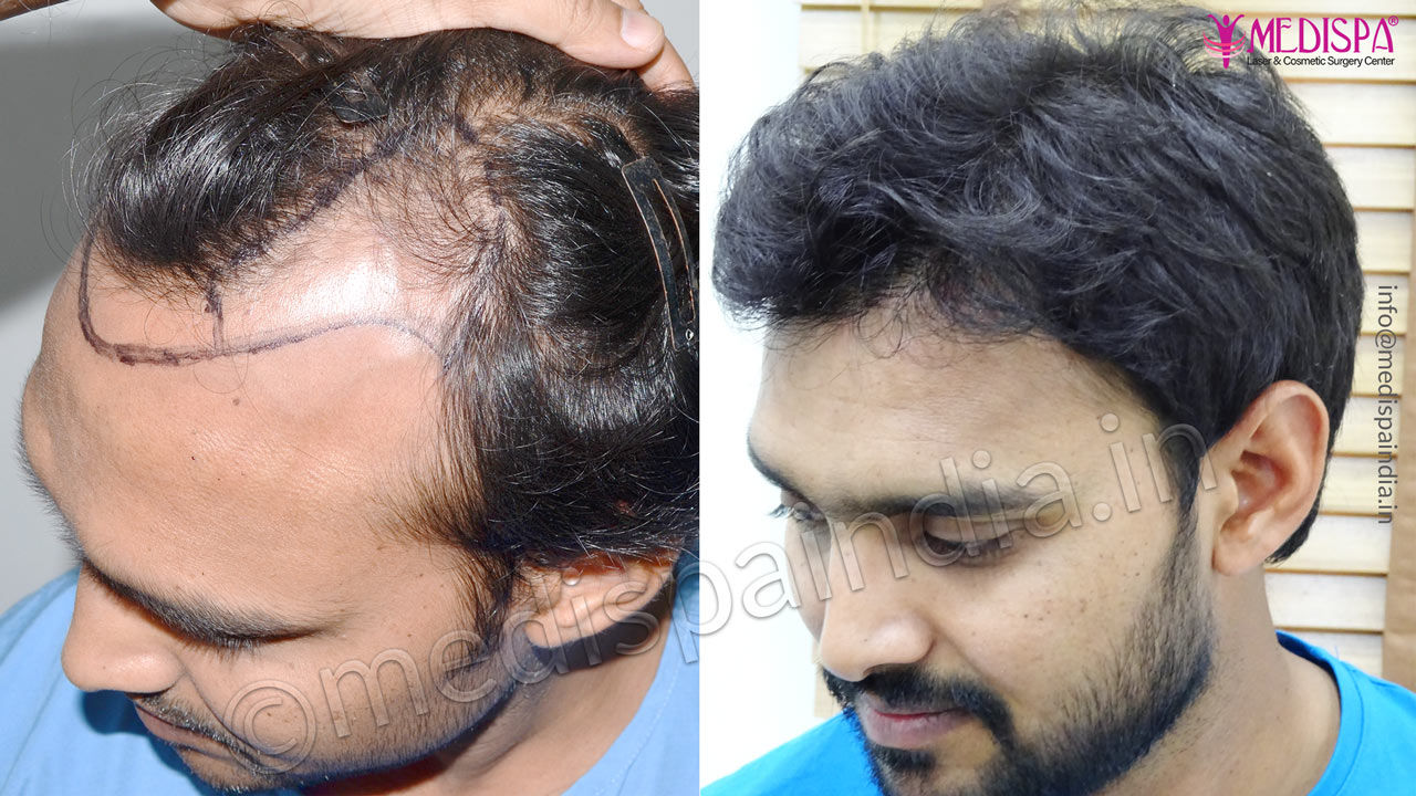 Top Hair Transplant Clinics In Pune Hair Transplant Dubai Cost